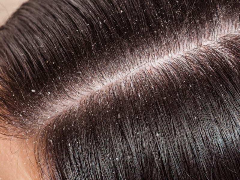 Dandruff Causes and Home Remedies: रूसी के कारण और उसे दूर करने के ...