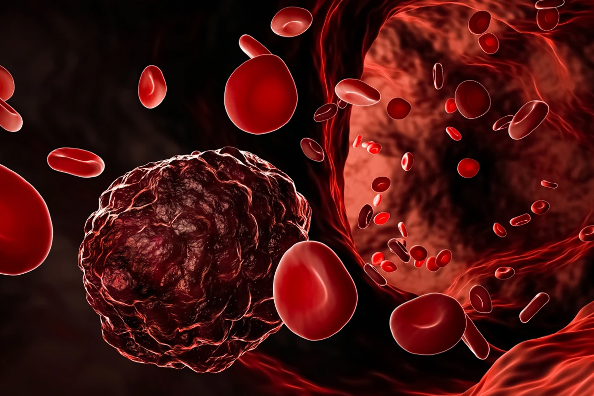 Blood Cancer की पहचान: जानें प्रकार और निदान करने वाले परीक्षणों के ...