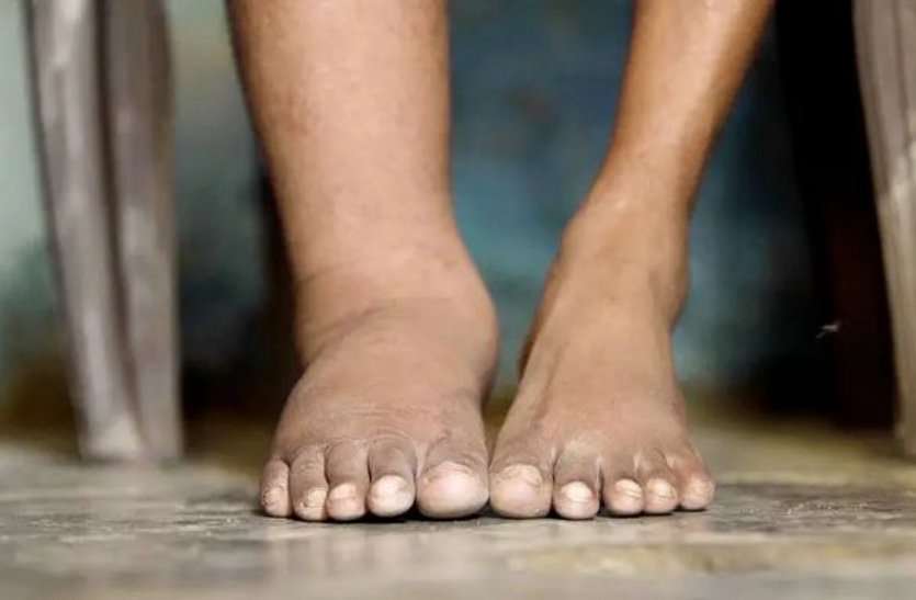 फाइलेरिया की पहचान के लिए आज से चलेगा अभियान, नए मरीजों की होगी पहचान ...