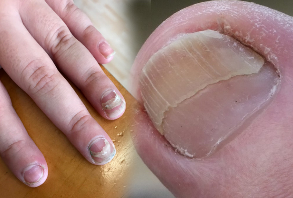 नाखूनों से पता चलेगा कि आपको विटामिन B12 की कमी है, जानें ये 3 संकेत ...