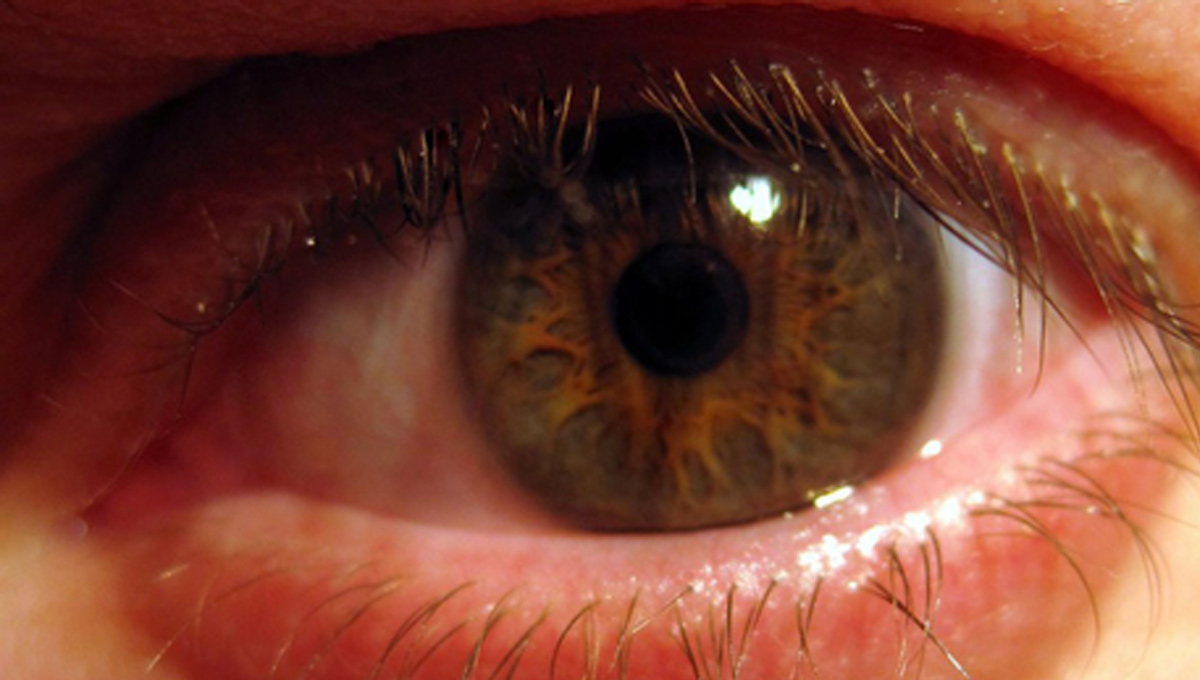 आंखों का ‘खून’ बताएगा माइग्रेन का दर्द! नए शोध में चौंकाने वाला खुलासा