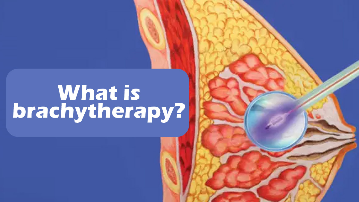कैंसर के उपचार में एक अच्छा और प्रभावी विकल्प है Brachytherapy