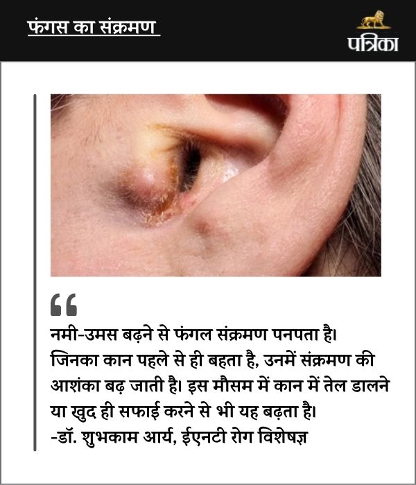 Fungal Ear Infections : मानसून में कान में फंगस का संक्रमण: कान बंद और ...