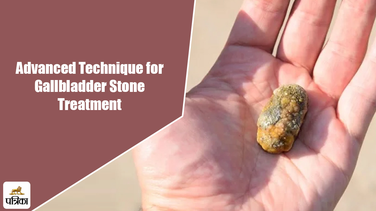 Gallbladder Stones: स्पाई कोलांजियोस्कोपी तकनीक से सफलतापूर्वक निकाली ...