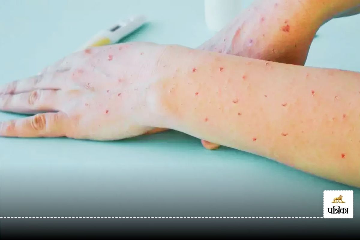 MPox Alert in Jaipur : जयपुर में विदेश से लौटे यात्री में एमपॉक्स के ...