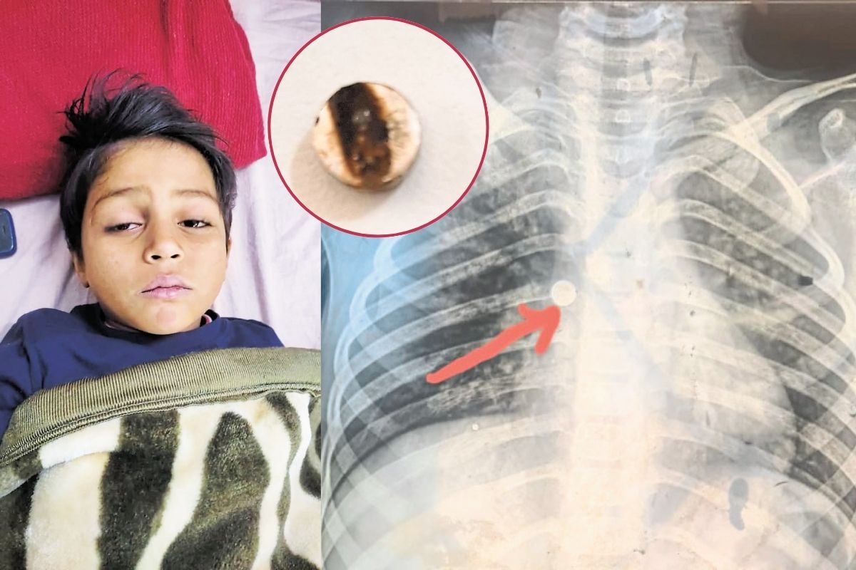 6 साल के बच्चे ने खेल-खेल में निगल लिया सेल, फेफड़े में 3 दिन फंसा रहा ...