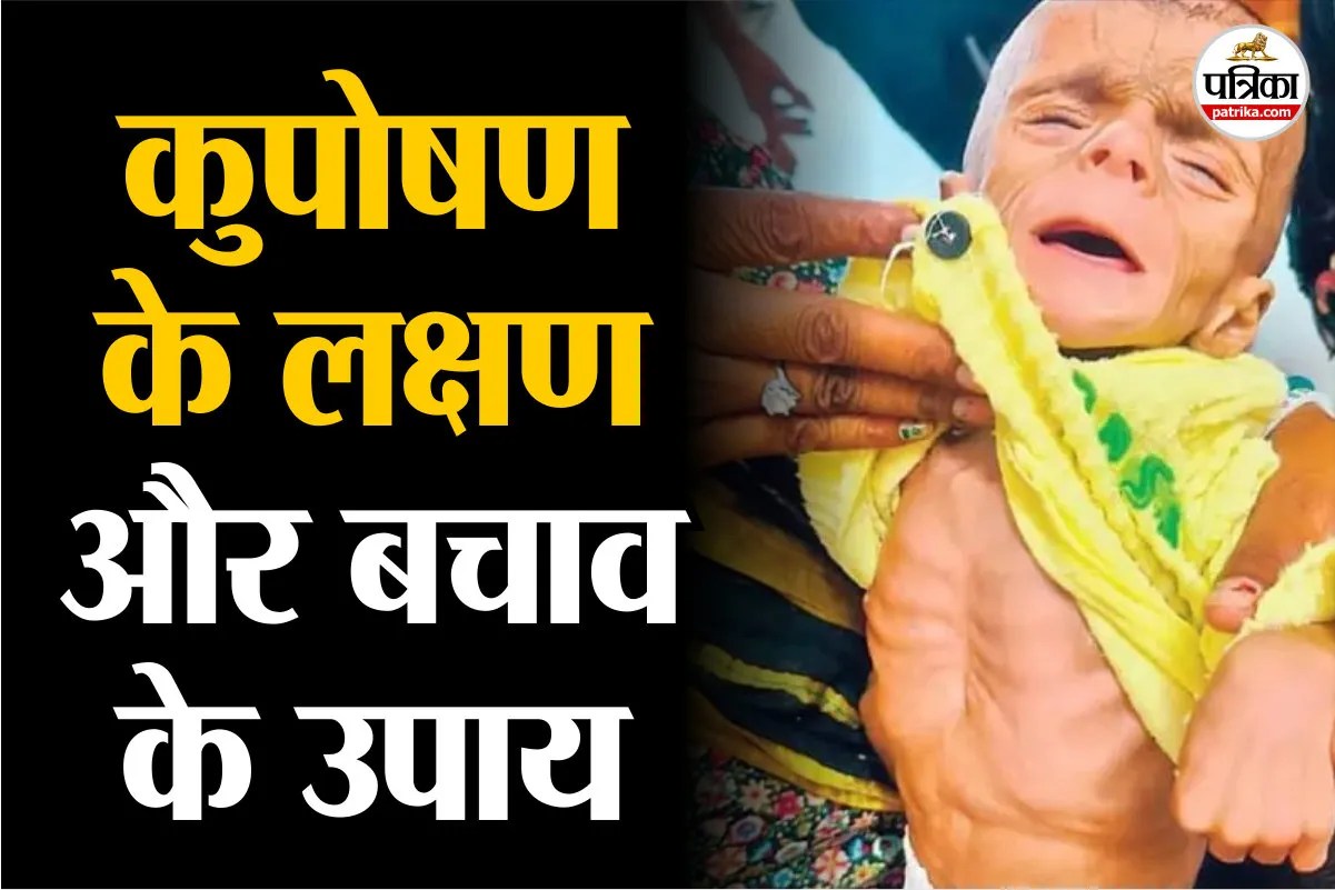 Kuposhan: मध्य प्रदेश में कुपोषण ने फिर ली मासूम की जान, जानिए इसके लक्षण और समय रहते इलाज के ...