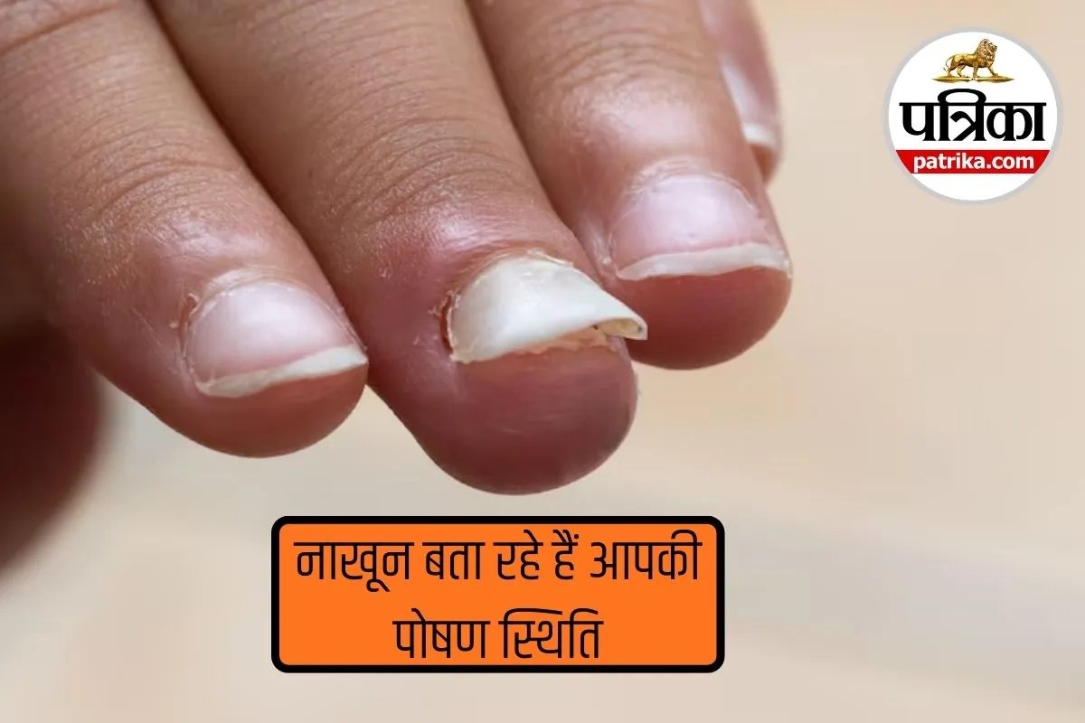 Nail Health Warning Signs: नाखूनों का अचानक बदलता रंग, ये 5 हेल्थ ...